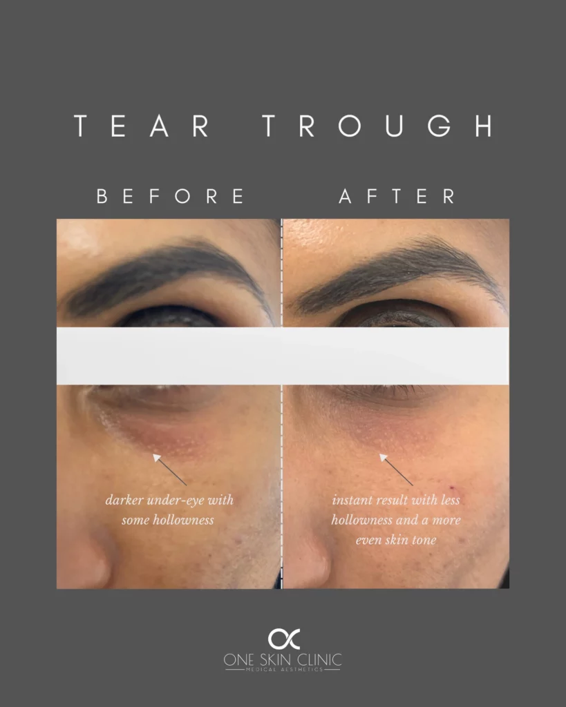 Tear Trough Treatment - Skin Treatment, Harley Street, Cosmetic Surgery