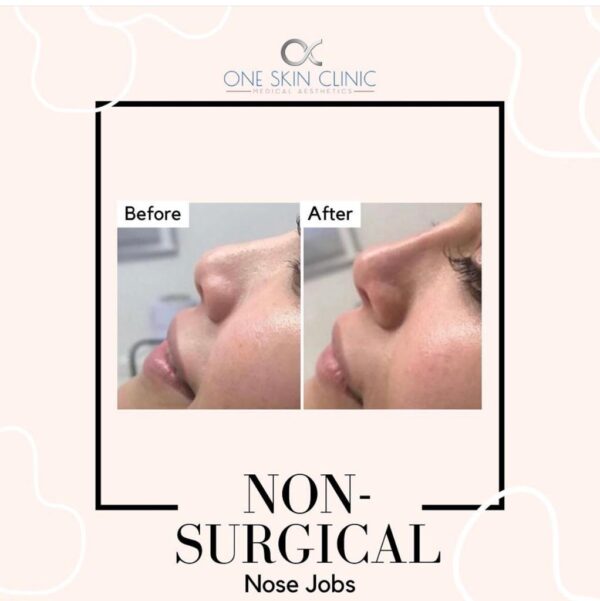 Non-Surgical Nose Job - Skin Treatment, Harley Street, Cosmetic Surgery